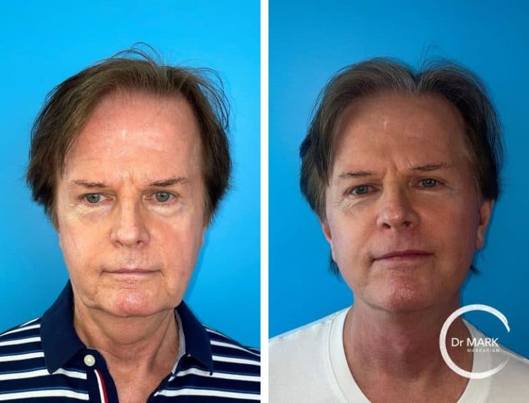 Plastic Surgery for Men - Expert Plastic Surgeon: Dr. Mark Markarian